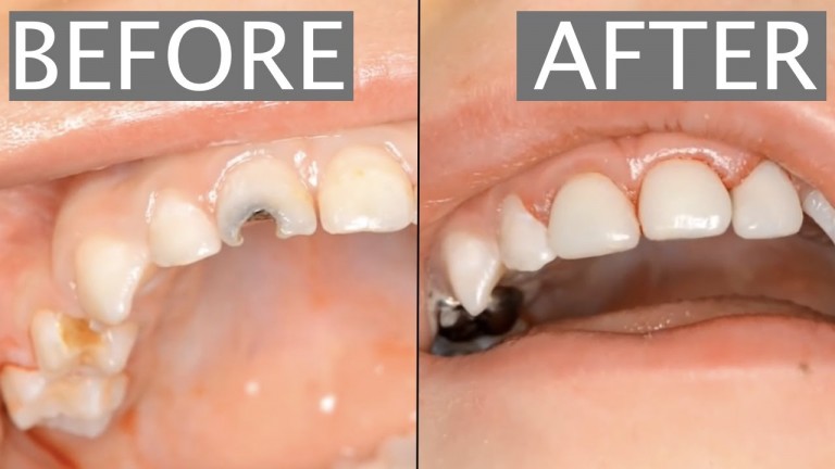 How to build-up an upper primary anterior - دكتور رضا سفينه